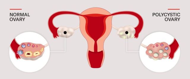 Mengenal PCOS dan Gejalanya yang Bisa Kamu Prediksi Sejak Dini